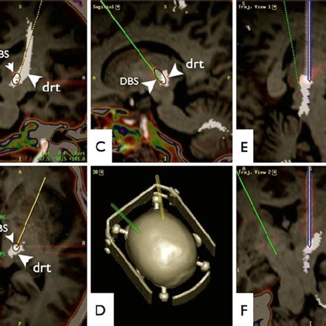 Pdf A Role Of Diffusion Tensor Imaging Fiber Tracking In Deep Brain Stimulation Surgery Dbs