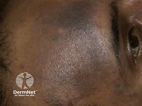 Eczema On Face African American