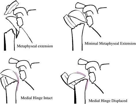 Classification Fracture Humerus Proximal At Frances Garrison Blog