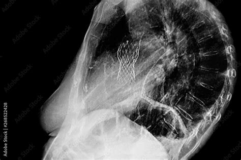 Aortic Valve Replacement Chest X Ray My Xxx Hot Girl