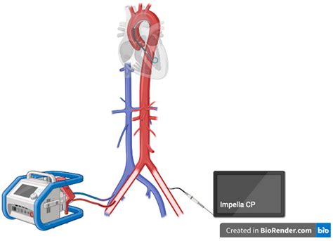 Left Ventricle Unloading In Va Ecmo Encyclopedia Mdpi