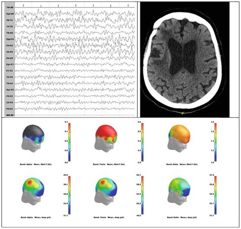 Clinical Applications Of Brain Mapping In Epilepsy Intechopen