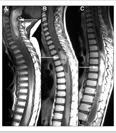 Magnetic Resonance Imaging Of Spinal Cord Glioma Spinal Cord Gliomas