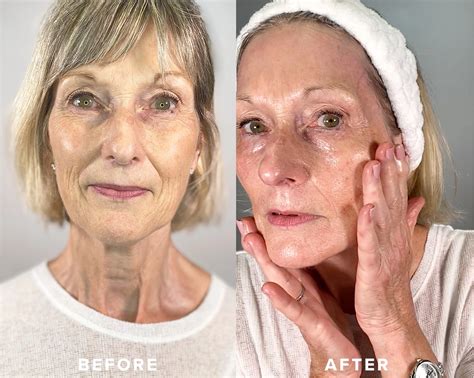 Non Surgical Face Lift