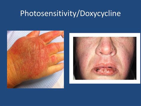 Dermatology Doc I Have This Rash Joseph S Baler M D September Ppt Download