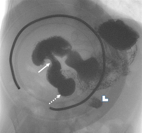 Annular Pancreas Barium