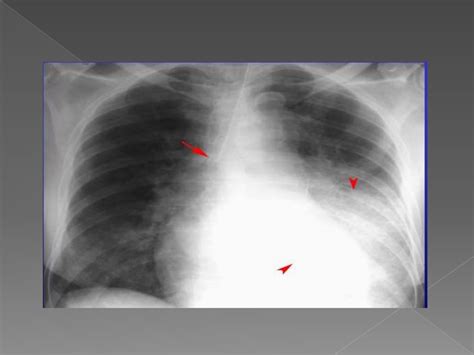 Chest Radiology In Icu