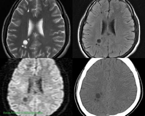 Dr Balaji Anvekar Frcr Enlarged Perivascular Virchow Robin Spaces