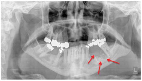 Osteonecrosis Of The Jaw Radiograph