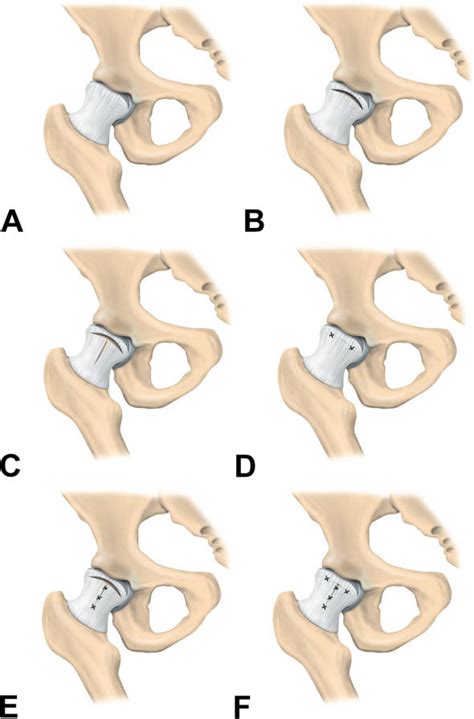 Capsulotomy And Capsular Repair Techniques A Hip Joint B