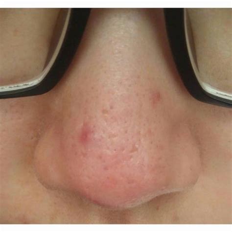 What Types Of Scars Are On My Nose With Pics Help Plz Acne Scars Acne Org Forum