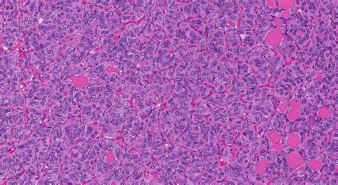 Follicular Variant Papillary Thyroid Carcinoma Atlas Of Pathology