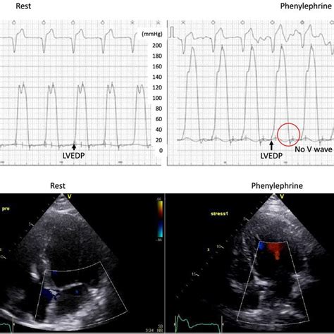 Waveform Recording Of The Intra‐left Ventricular Pressure And The Pcwp