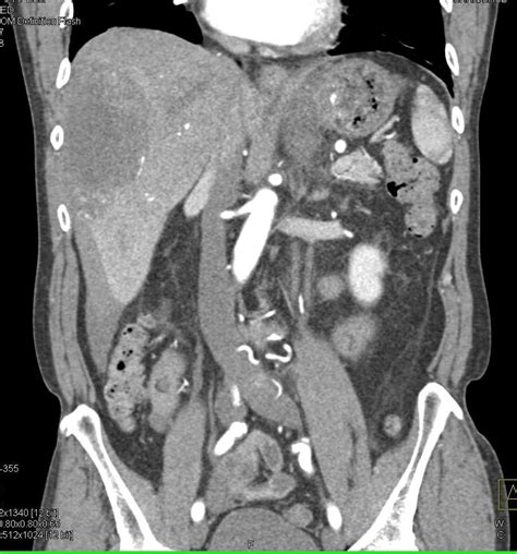 Carcinoma Gastroesophageal Ge Junction With Metastases Esophagus