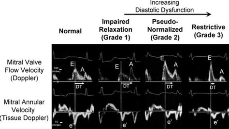 Diastolic Dysfunction Chart
