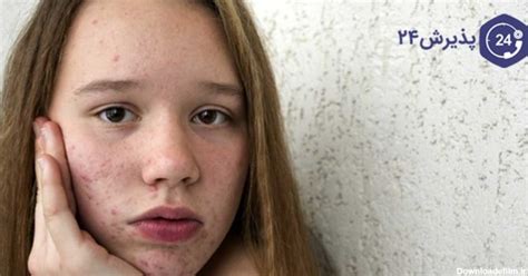 عکس دختر با صورت پر جوش