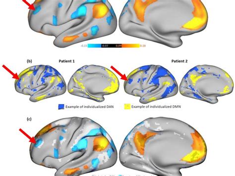 Individualized Precision Targeting Of Dorsal Attention And Default Mode Networks With Rtms In