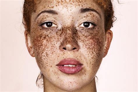 ТОП 30 советов как избавиться от пигментных пятен на лице