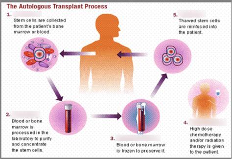 The Autologous Transplant Process Diagram Quizlet