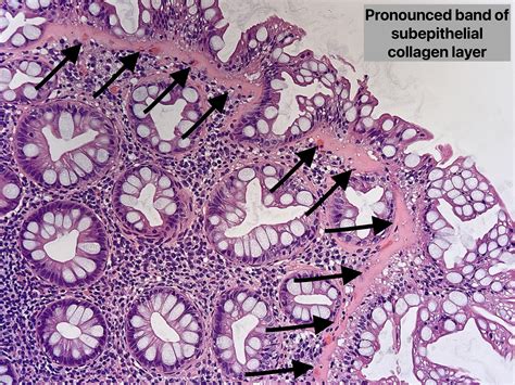 Hyperplastic Polyp Pathology Outlines Clinical Pathology Intestinal