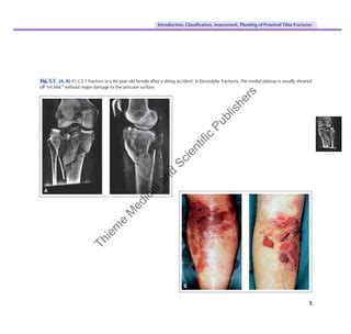 Guidelines In Fracture Management Proximal Tibia By Babhulkar PDF