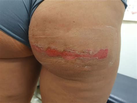 Mum Says Shes Left With Scar That Looks Like A Sex Toy After Accidentally Burning Her Bum On