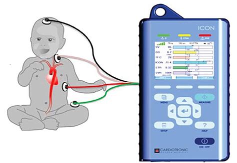 Table 1 From Non Invasive Cardiac Output Monitoring And Assessment Of Fluid Responsiveness In