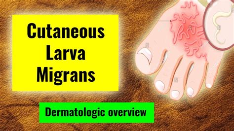 Cutaneous Larva Migrans