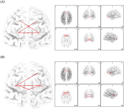 Phase Synchronization Analysis Demonstrating Increased Functional