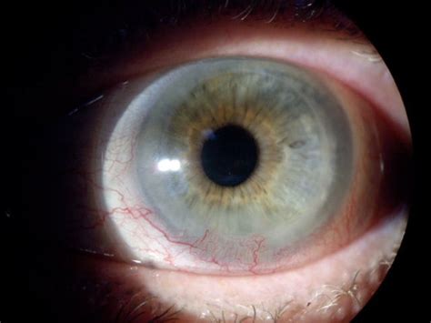 Nacor Pathology Andor Contact Lens Anomalies Flashcards Quizlet