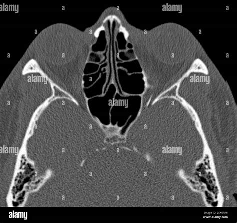 Normal Sinuses Computed Tomography Ct Scan Of An Axial Section Through The Skull Showing The