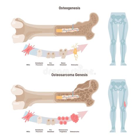 Osteosarcoma Bone Cancer
