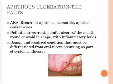 Aphthous Ulcer Causes
