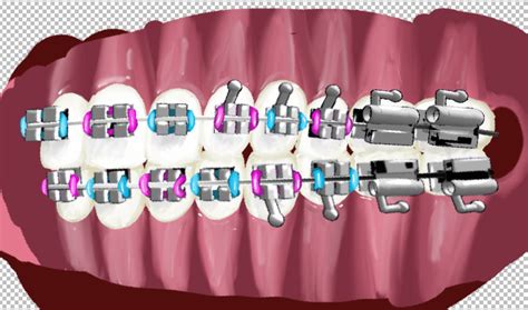Perfect Modern Braces Oral Cavity By Agilebag4059 On Deviantart