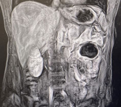 Small Bowel Mesenteric Mass A Rare Mystery Acs