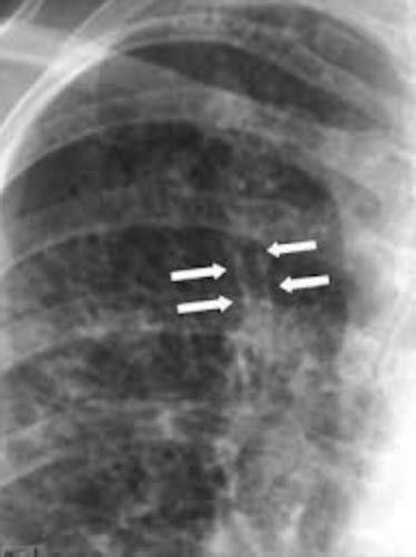 Pulm Flashcards Quizlet