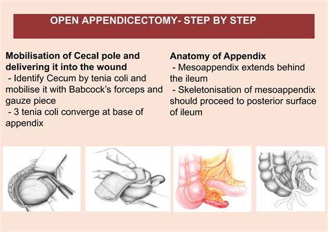 Acute Appendicitis Appendicectomy Open And Laparoscopic Pdf Surgery Medical Health