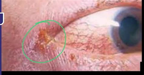 Allergic Conjunctivitis Treatment Causes