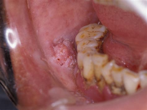 Val Object Detection Dataset By Mouth Detection