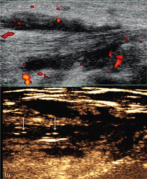 Large Erosion Arrow Heads In A Metacarpal Head Ceus Perceives Two