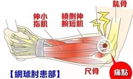 网球肘最全康复方案在这儿 知乎