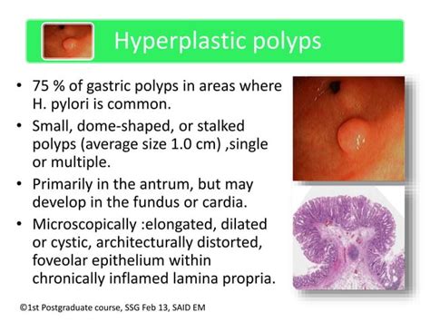 Management Of Gastric Polyps Ppt