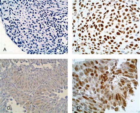 Predictive Value Of P53 And Prb Expression In Superficial Bladder
