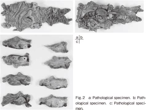 Figure 2 From A Case Of Goblet Cell Carcinoid With Peritoneal Dissemination That Was