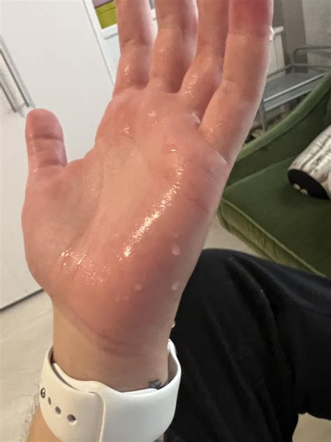 Red Hands R Hyperhidrosis