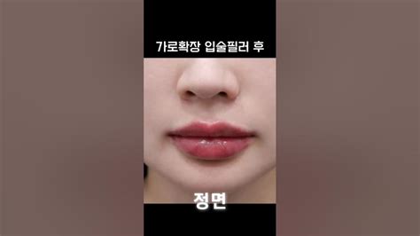 비대칭 입술도 밸런스있게 교정하는 가로확장입술필러‼️ Youtube