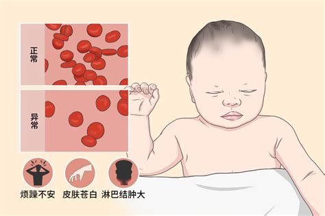 小儿缺铁性贫血 有来医生