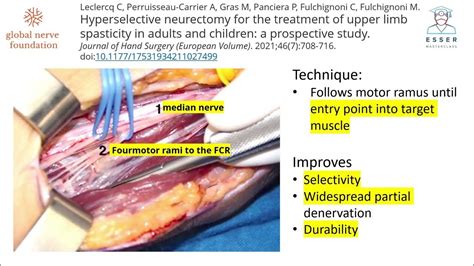 Hyper Selective Neurectomy And Contra Lateral C7 Transfer For Spasticity Youtube