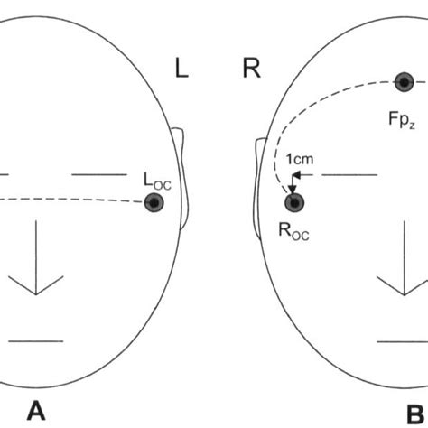 Example Of A1 Subtype Of Cyclic Alternating Pattern Cap Expression In