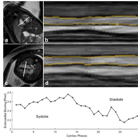 Left Ventricular Myocardial Wall Motion And Endocardial Blurring Left Download Scientific
